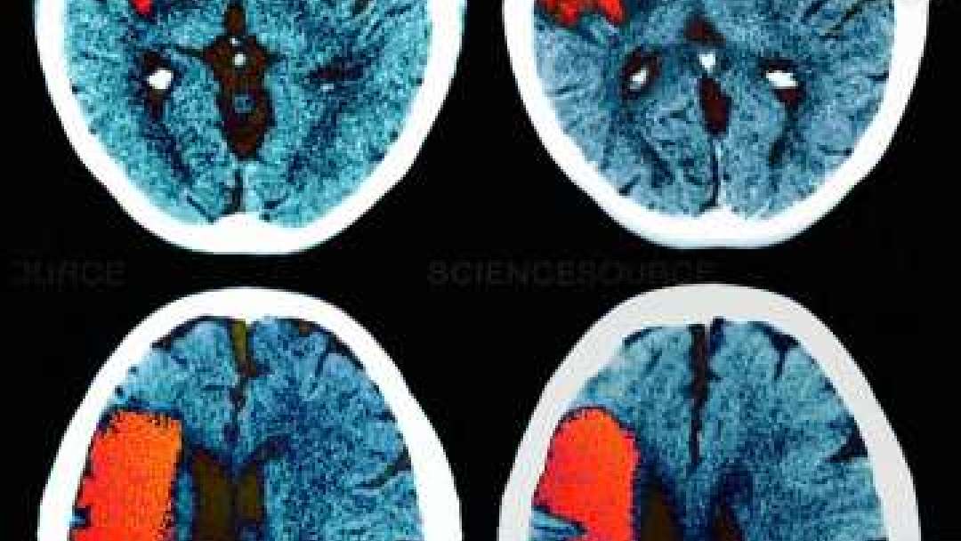 UCLA Neurology – Neurologists in Los Angeles | UCLA Health