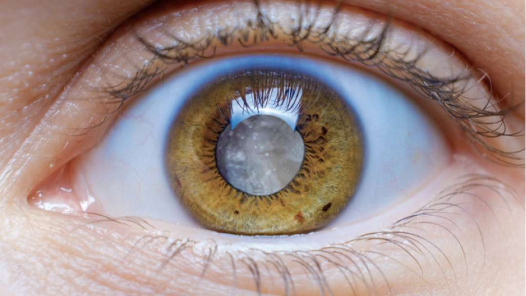 Department of UCLA Ophthalmology | UCLA Health
