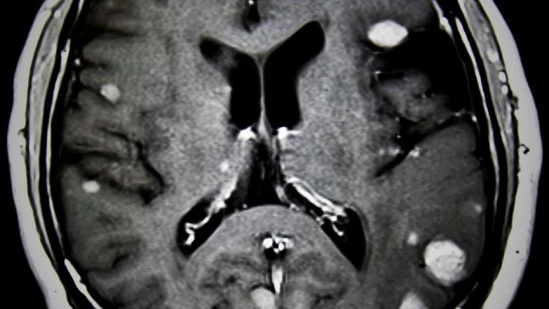 Treatments - Radiation Oncology | UCLA Health Jonsson Comprehensive ...