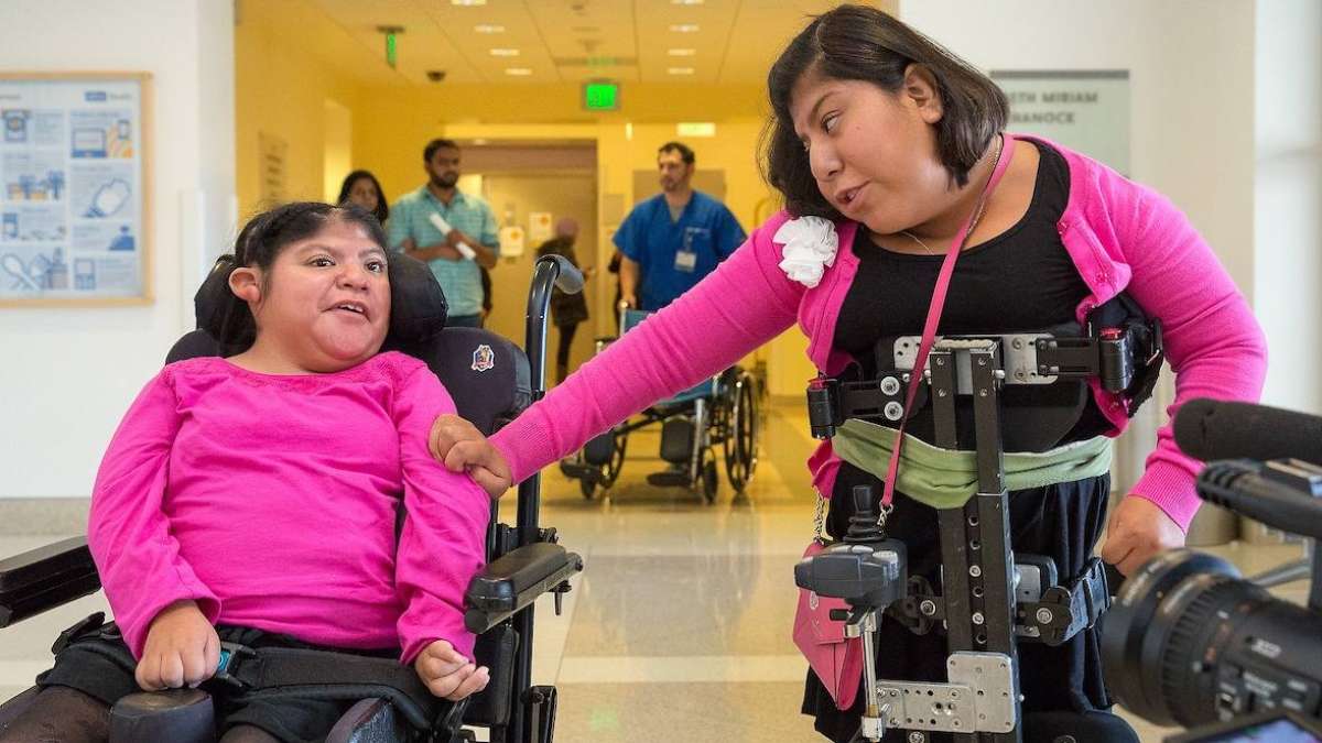 conjoined twins examples