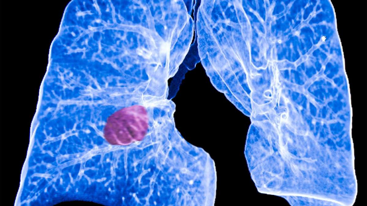 lung scan without contrast