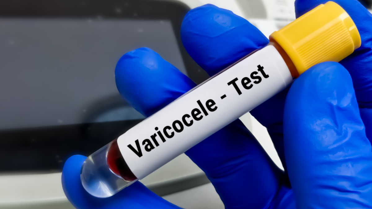 UCLA Health research focuses on varicoceles and male fertility | UCLA ...