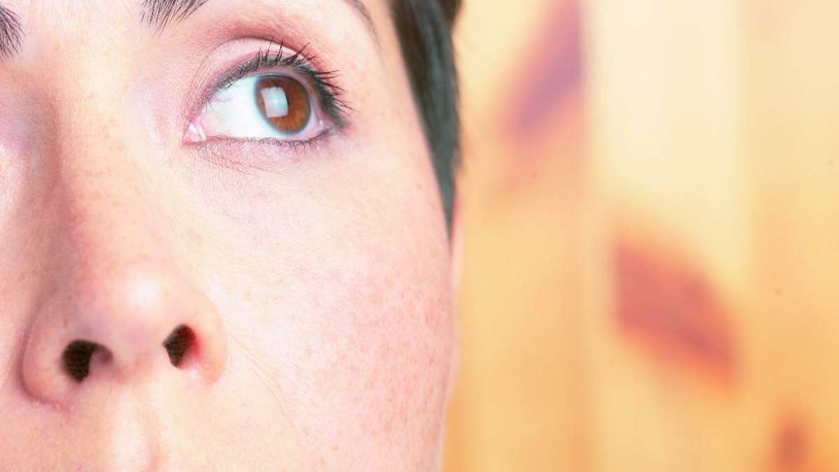 people without eyelashes