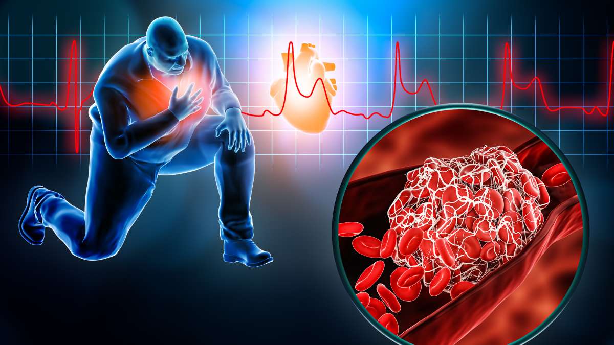 Heart attack and cardiac arrest are not the same thing | UCLA Health