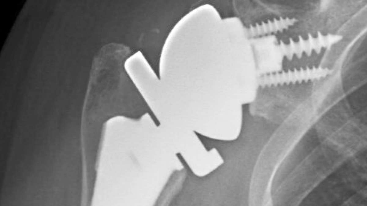 How common is Shoulder Replacement Surgery? | UCLA Health