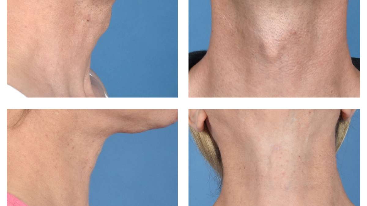 UCLA surgeons develop new technique to reduce Adam’s apple without neck ...