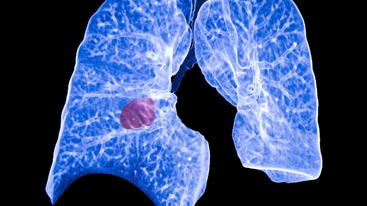 Long-term exposure to ozone may increase risk of lung and ...