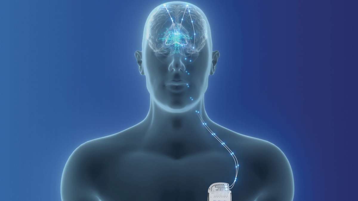 Multiple treatment options available to patients with epilepsy | UCLA ...