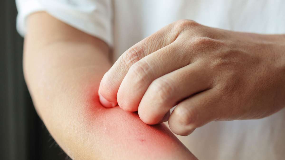 Post-traumatic dermatitis triggered by skin injury | UCLA Health