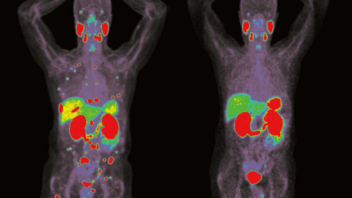 Theranostics treatments for cancer underway at UCLA Health - Cancer ...
