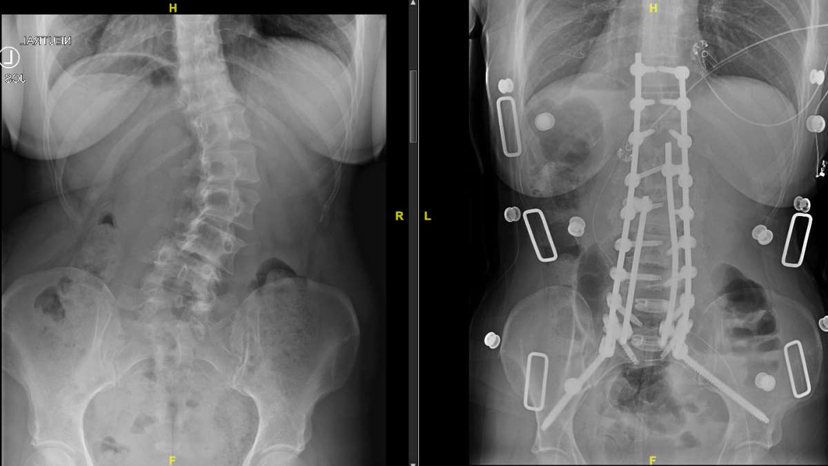 Advances in spine surgery open the door to relief for a broader ...