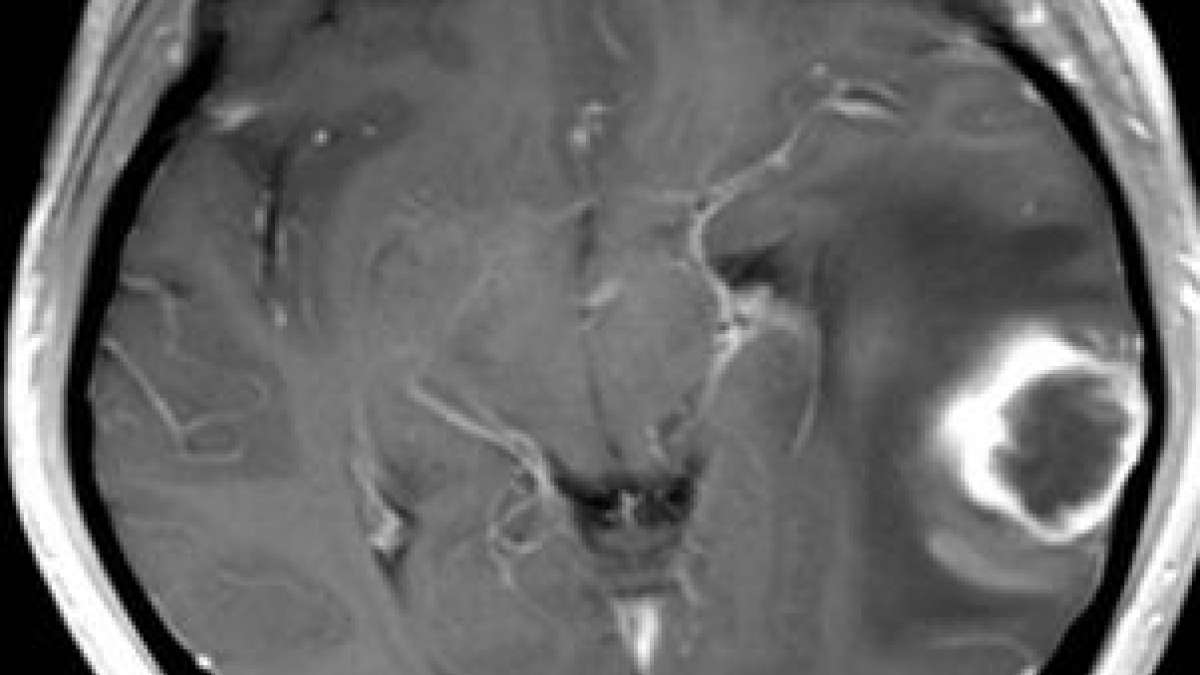 Crystal ball for brain cancer? | UCLA Health