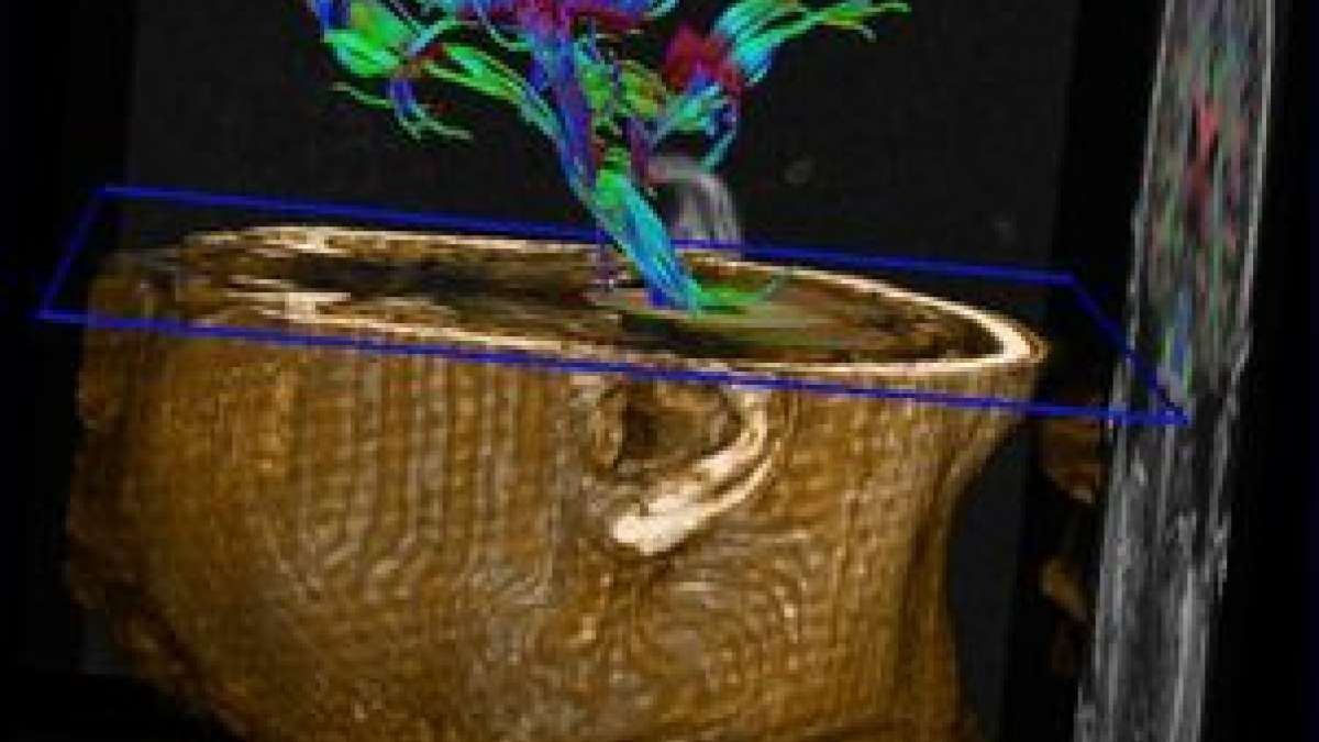 Physical decline caused by slow decay of brain's myelin | UCLA Health