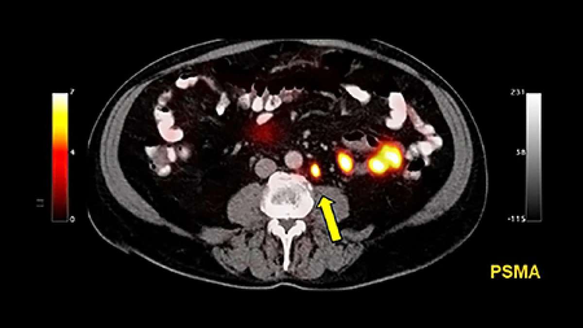 New imaging method is more effective at detecting prostate cancer ...