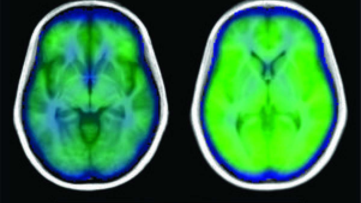 Study provides more evidence that sleep apnea is hurting your brain ...