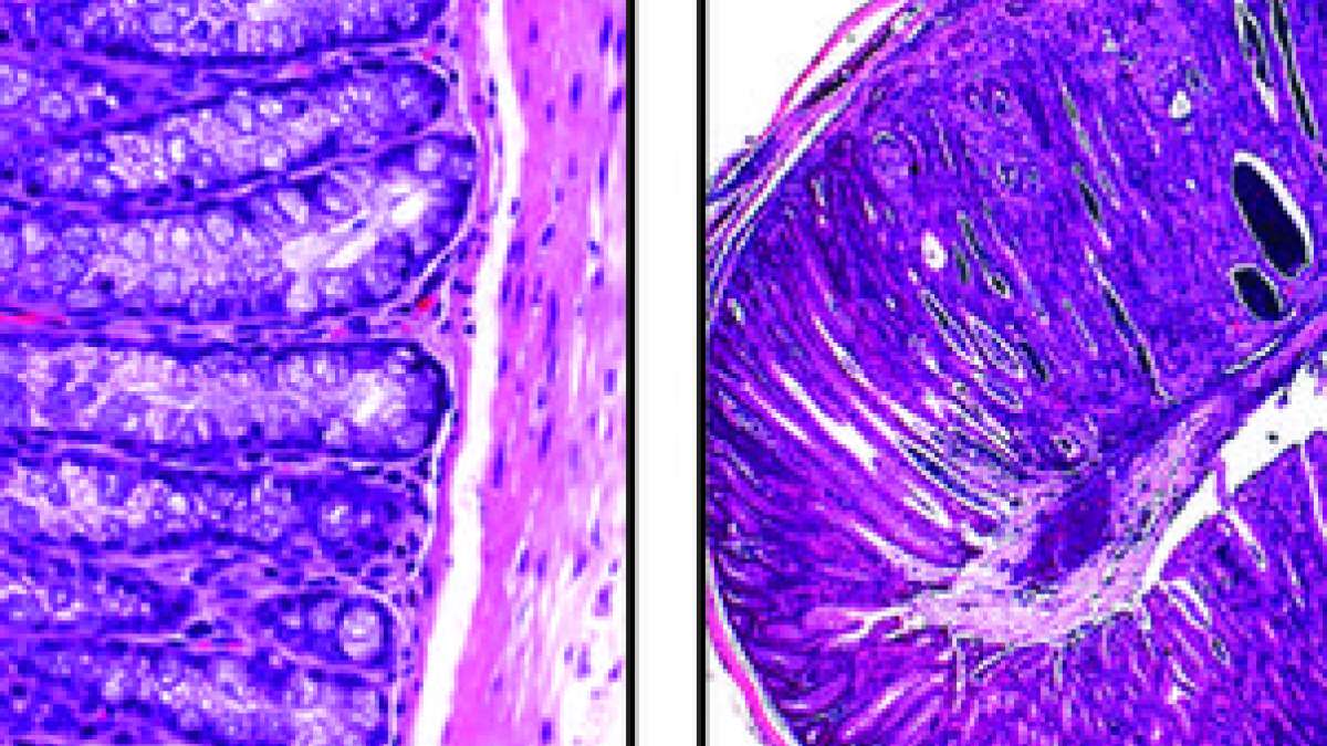 UCLA-led study identifies genetic factors involved in pediatric ...