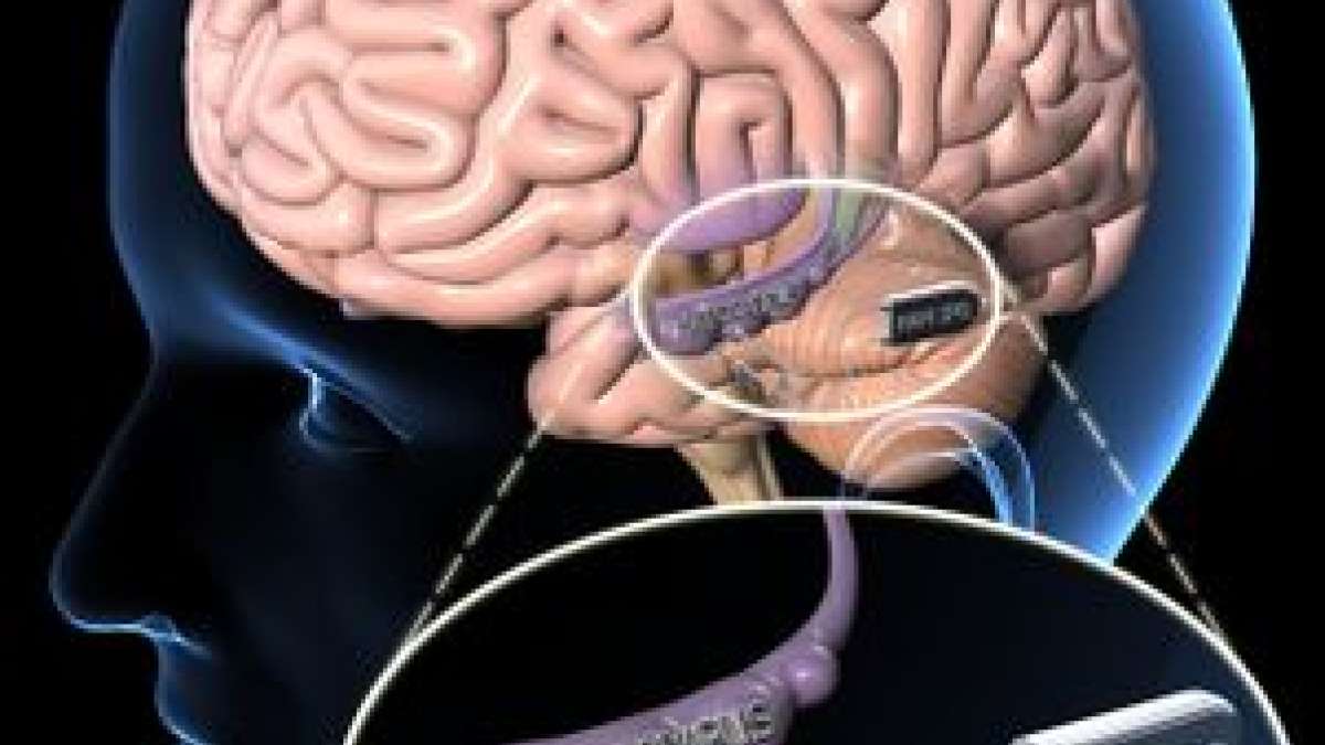 UCLA to develop 'brain prosthesis' to help brain-injured patients ...