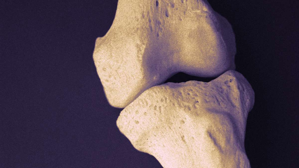 Bone bruising is localized area of microfractures | UCLA Health