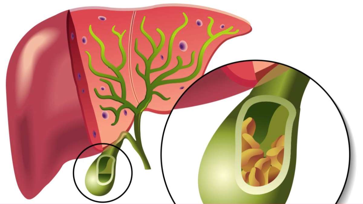 Gallstones the result of hard bile deposits | UCLA Health