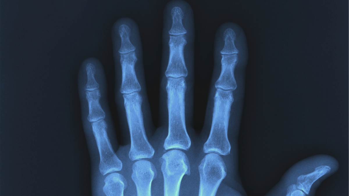 Calcium supplement AlgaeCal can increase bone density | UCLA Health