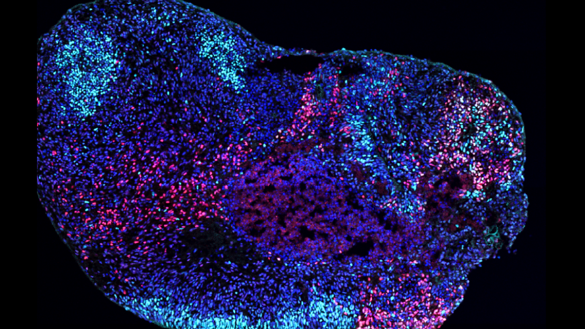 UCLA researchers find how epilepsy genes disrupt different brain ...