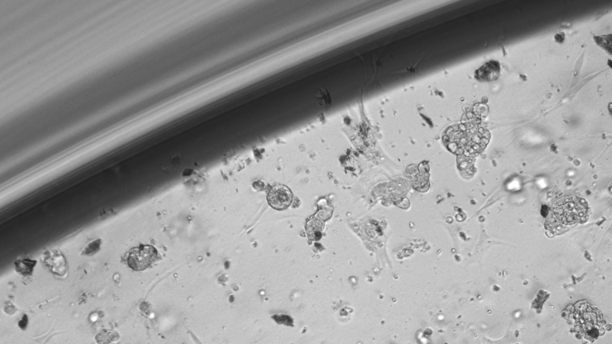 Lab-grown mini tumors could help identify personalized treatments for ...