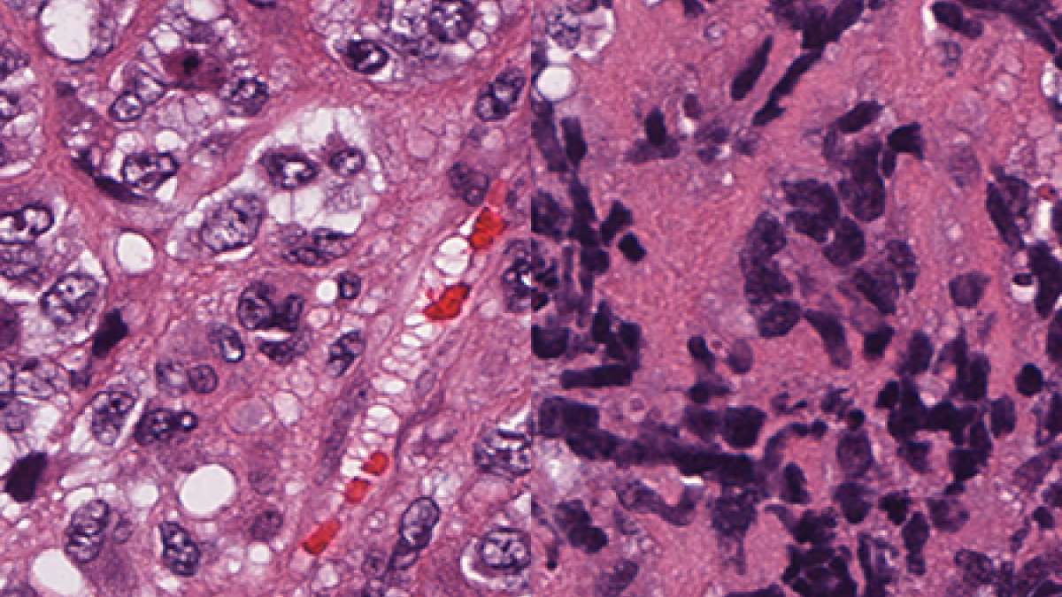 Similarities of small cell cancers to blood cancers could lead to ...