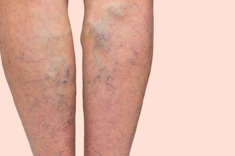 Blood clots: What you need to know | UCLA Health