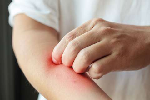 Post-traumatic dermatitis triggered by skin injury | UCLA Health