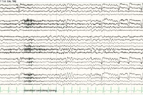 EEGs help predict epilepsy risk in children with autism spectrum ...