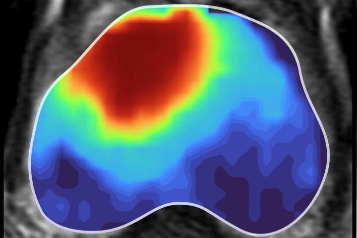 AI model could help improve outcomes of prostate cancer focal therapy ...