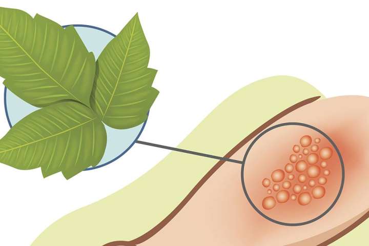 Rashes from poison ivy and oak: Tips to bring you relief | UCLA Health
