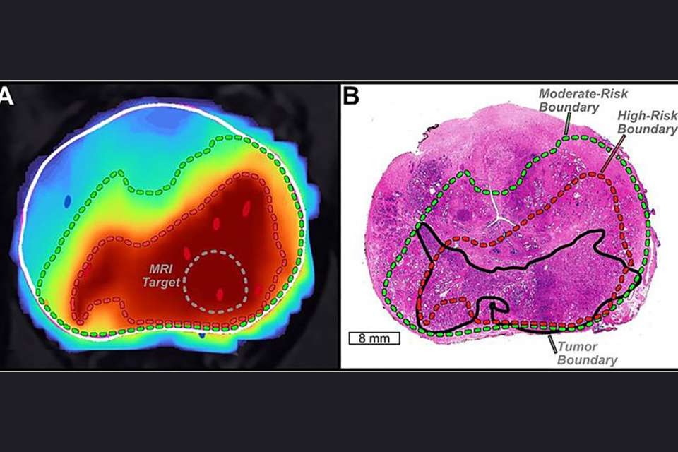 Study finds possible early predictor of successful transcranial ...