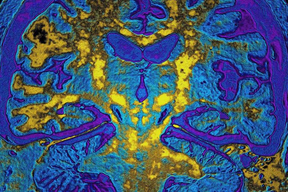 New blood test reads messages from the brain | UCLA Health
