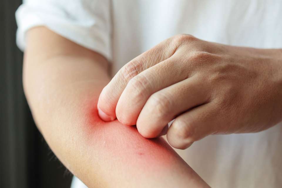 Post-traumatic dermatitis triggered by skin injury | UCLA Health