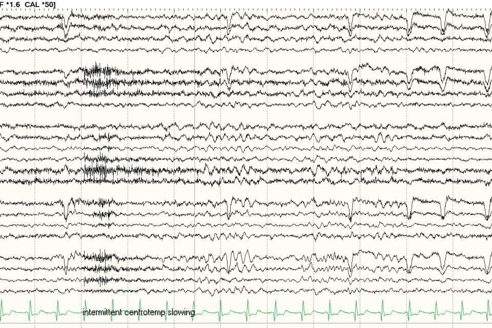 EEGs help predict epilepsy risk in children with autism spectrum ...