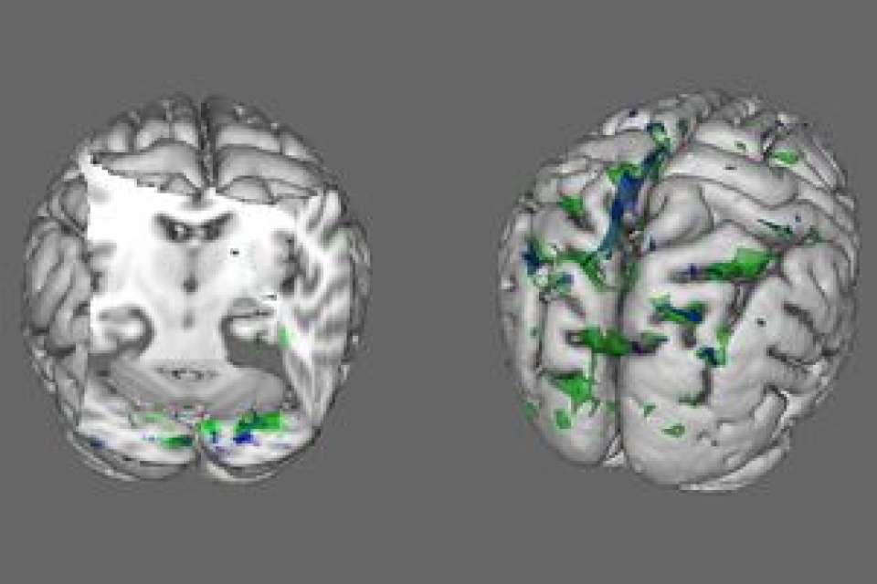 UCLA study shows that people with anorexia and body dysmorphic disorder ...