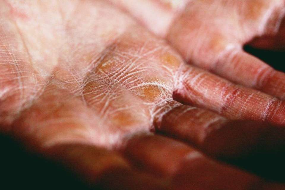 Atopic dermatitis is most common form of eczema | UCLA Health