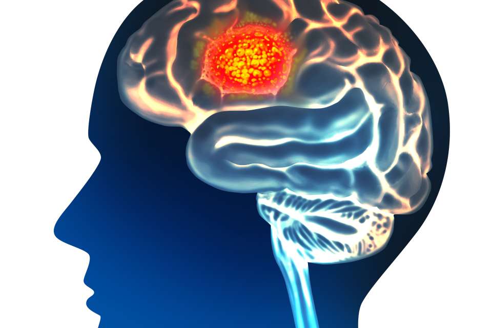 Overcoming bad genes | UCLA Health