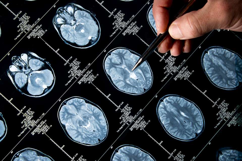 Researchers uncover key mechanism of brain repair in vascular dementia ...
