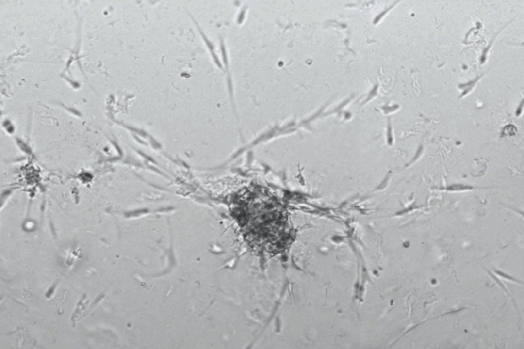 Finding new treatments for genetic tumor-predisposition syndrome | UCLA ...