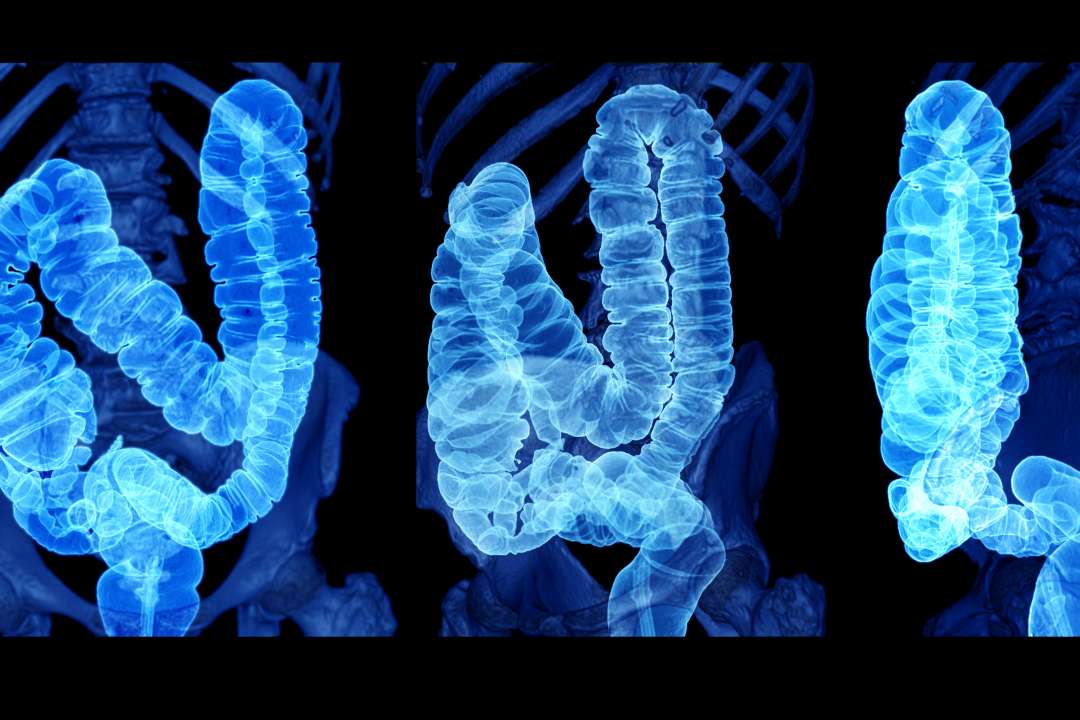 Analysis finds alarming rise in severe diverticulitis among younger ...