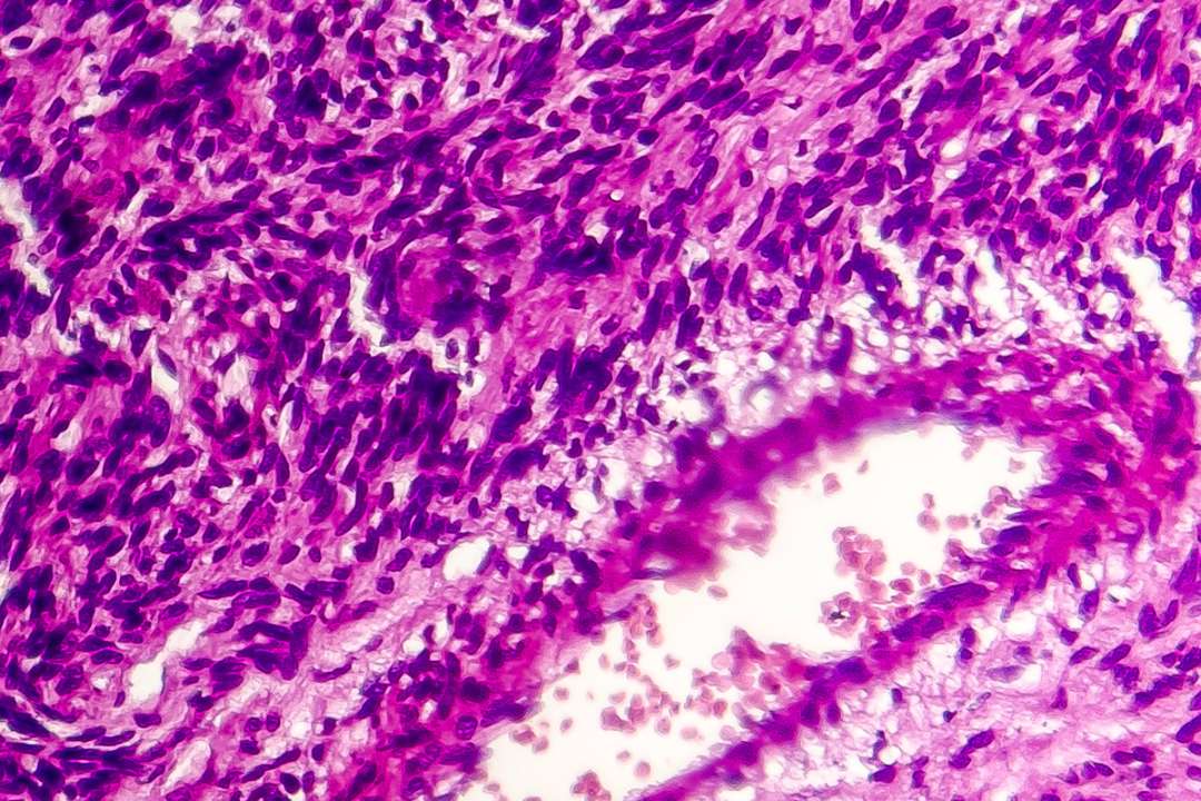 Study offers road map to personalized therapies for sarcoma and other ...