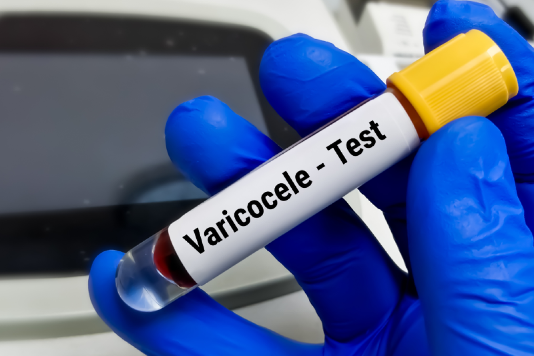 Varicocele: Varicose Veins in Testicles - Symptoms, Treatment - Urology ...