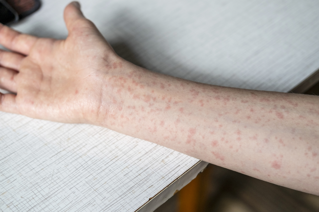 Spurred by outbreak, measles cases hit record high in the U.S. | UCLA ...