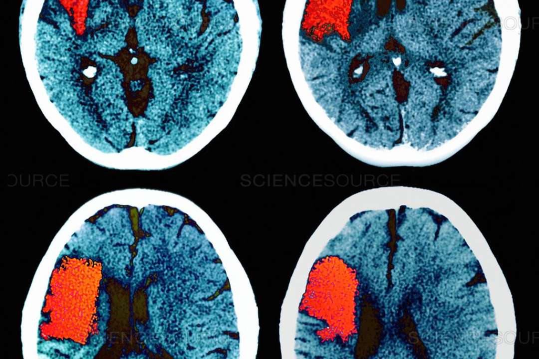 Understanding the stroke-dementia connection | UCLA Health
