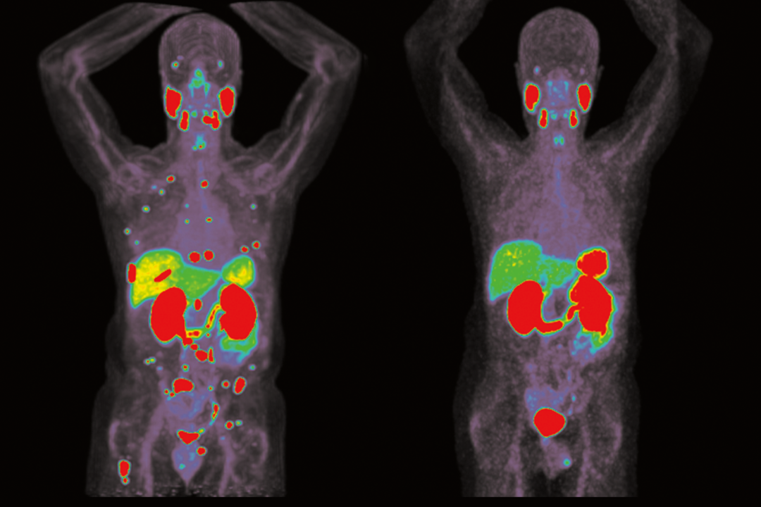 Theranostics treatments for cancer underway at UCLA Health - Cancer Services | UCLA Health ...