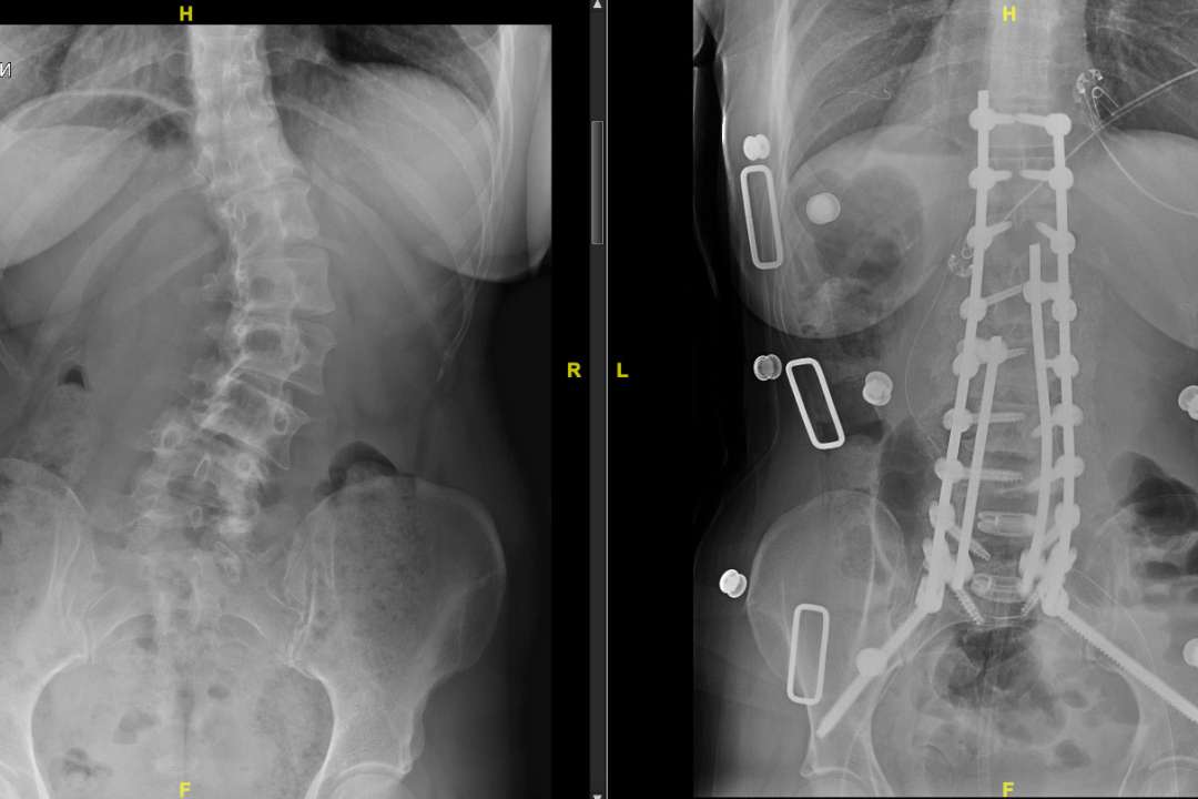 Advances in spine surgery open the door to relief for a broader ...