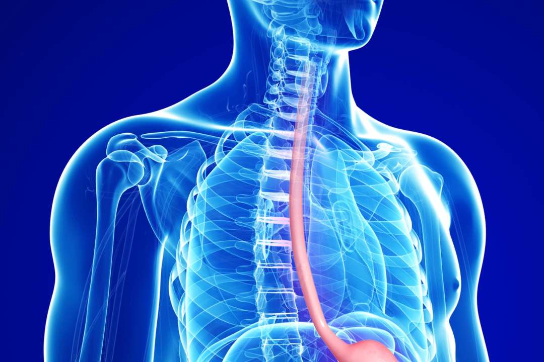 Schatzki’s ring causes restriction of esophagus | UCLA Health