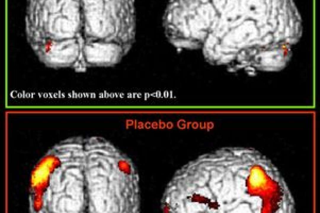 Alzheimer's drug may help mild memory loss, study shows | UCLA Health